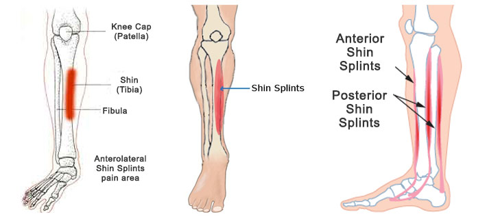 Shin Splints Chicago Foot Care Clinic Shin Splints Chicago Foot Care Clinic