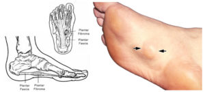 Plantar Fibromas (lumps in the arch of the foot) - Chicago Foot Care Clinic