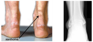 Xanthomas of the Achilles Tendon - Chicago Foot Care Clinic